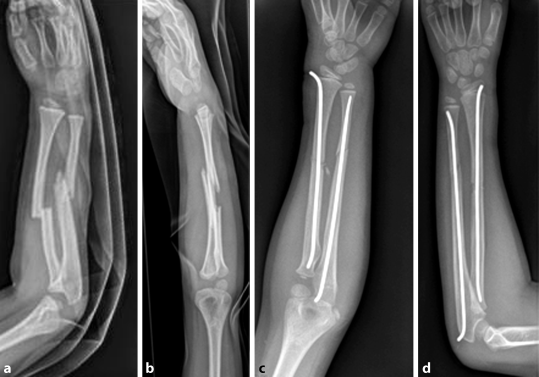 Behandlung der kindlichen Unterarmschaftfraktur | SpringerLink