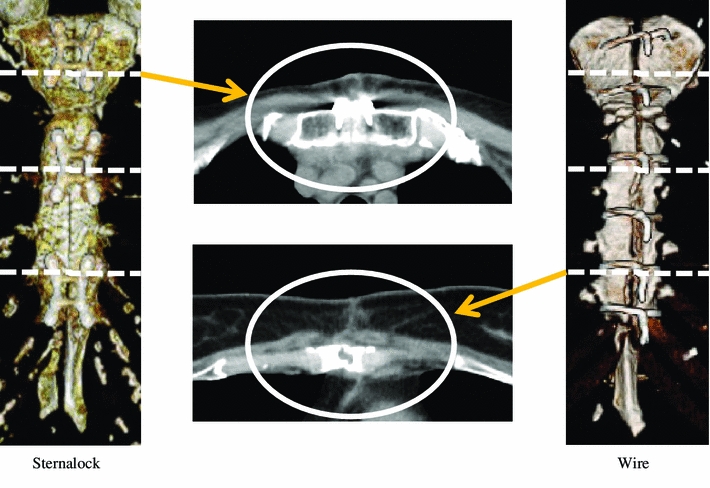 Sternalock plating system for elderly post-sternotomy patients ...