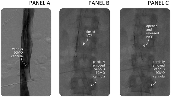 Safe ECMO femoral decannulation by placement of inferior vena cava ...