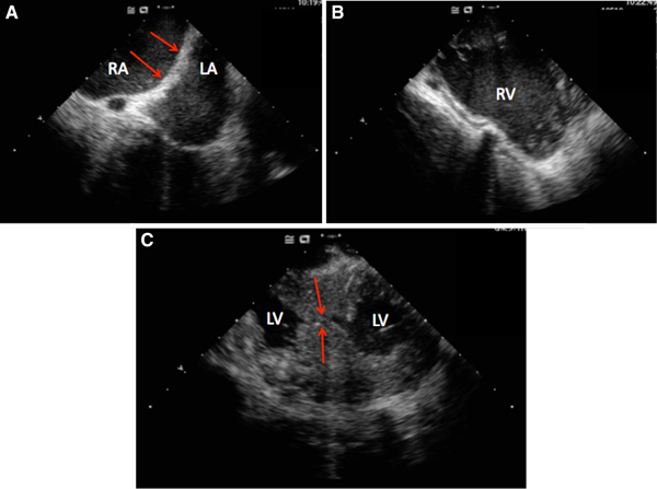 Catch 22: a case of incessant ventricular tachycardia post-left ...