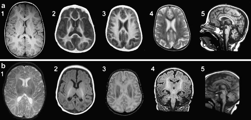 Microcephaly and simplified gyral pattern of the brain associated with ...