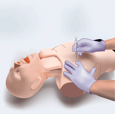 Erstversorgung des Patienten mit schwerem Thoraxtrauma | SpringerLink