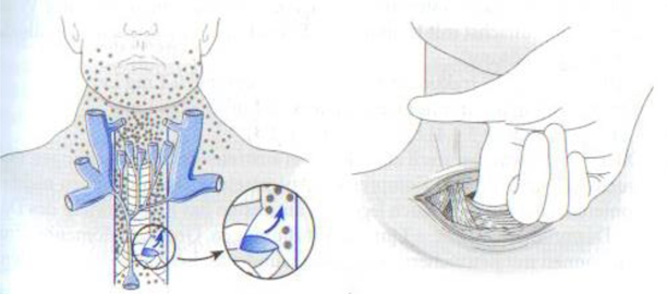 Erstversorgung des Patienten mit schwerem Thoraxtrauma | SpringerLink