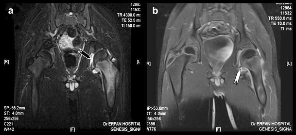 Bone marrow edema syndromes of the hip: MRI features in different hip ...
