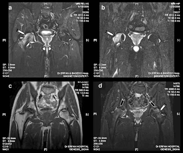 Bone marrow edema syndromes of the hip: MRI features in different hip ...
