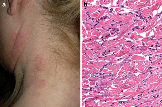 Cutaneous manifestations of Churg–Strauss syndrome: report of two cases ...