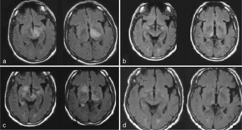 MRI findings of neuro-Behcet’s disease | SpringerLink