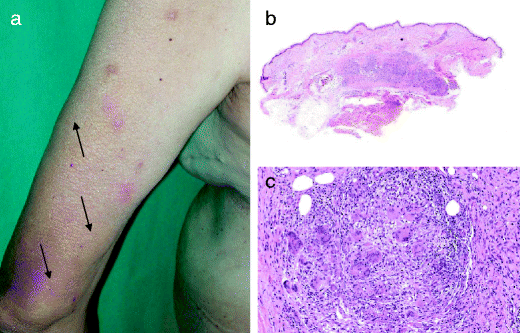Subcutaneous sarcoidosis: report of two cases and review of the ...