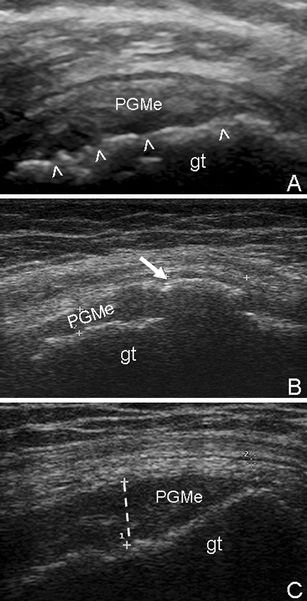 Ultrasound revealing subclinical enthesopathy at the greater trochanter ...