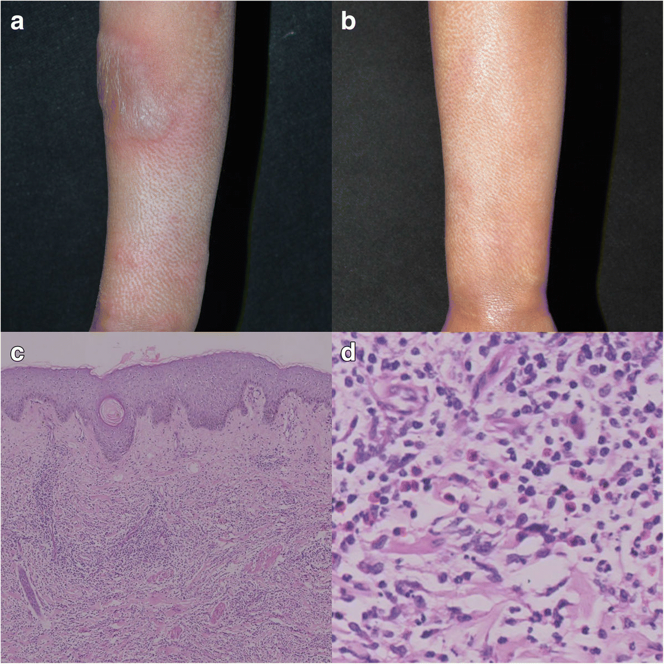 Systemic sclerosis-rheumatoid arthritis overlap syndrome complicated ...