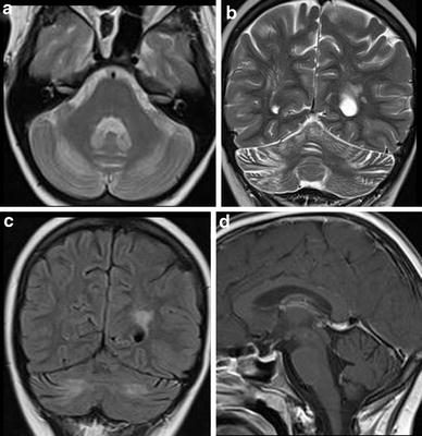 Hemophagocytic lymphohistiocytosis with neurological presentation: MRI ...
