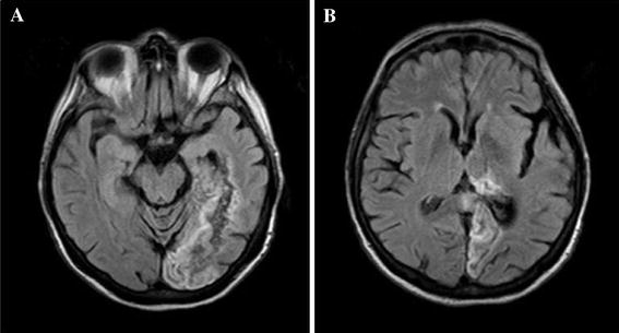 Alien hand syndrome in left posterior stroke | SpringerLink