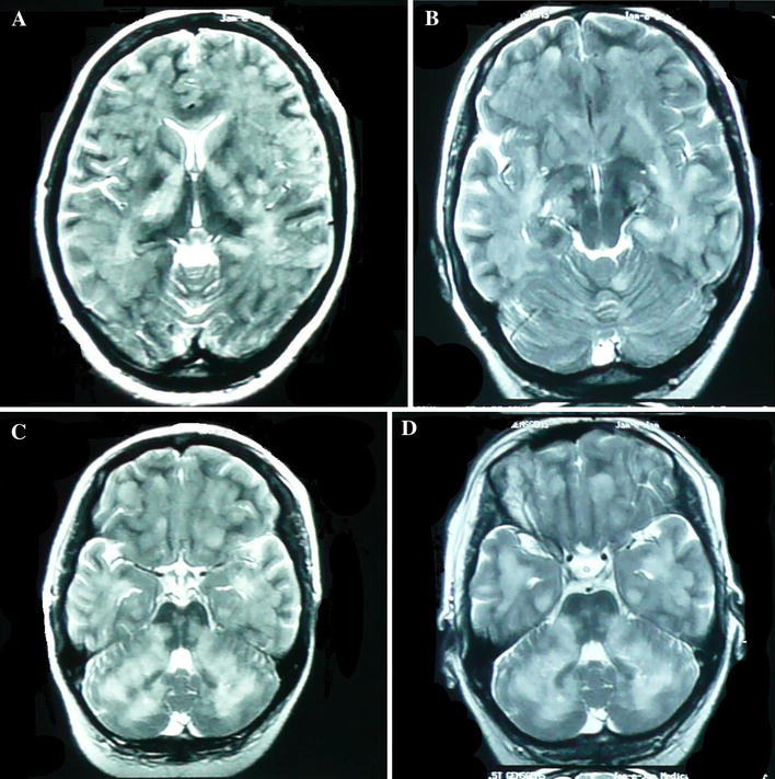 Fulminant multiple sclerosis (MS) | SpringerLink