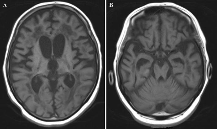 Fulminant multiple sclerosis (MS) | SpringerLink