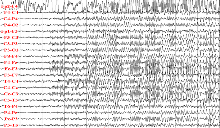 Lennox-Gastaut syndrome: a comprehensive review | SpringerLink