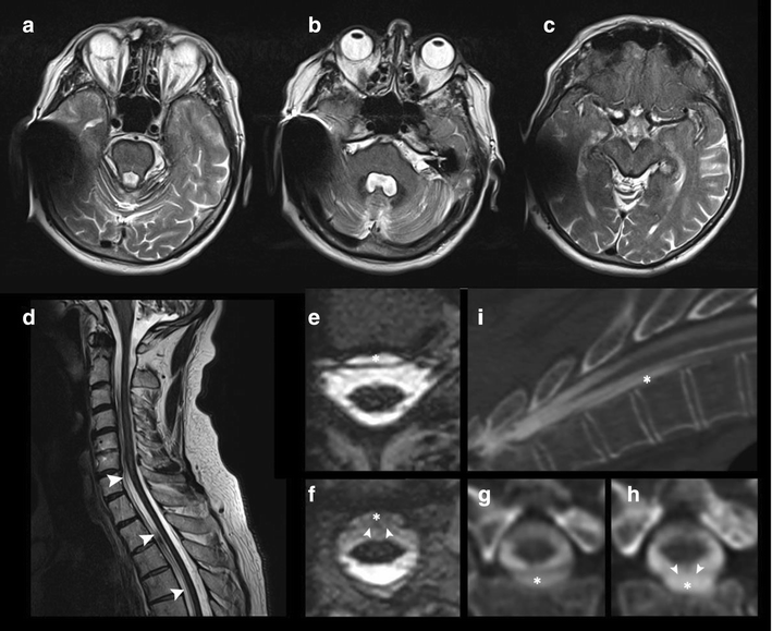 CT and MR myelography in superficial siderosis | SpringerLink