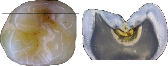 Performance of laser fluorescence at tooth surface and histological ...