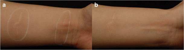 Treatment of hesitation marks on the forearm by the pinhole method ...