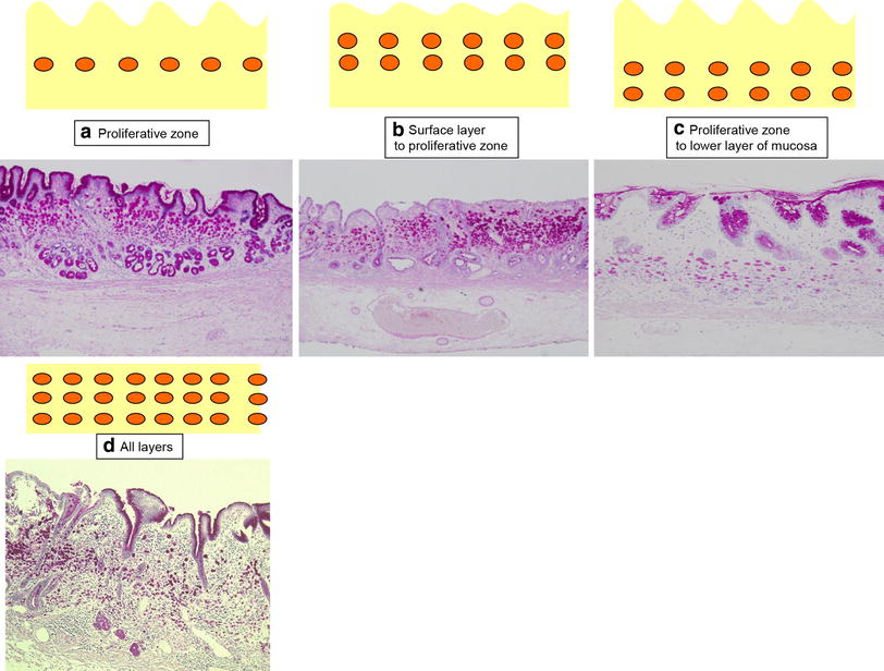 Biological behavior of the intramucosal Helicobacter pylori-negative ...