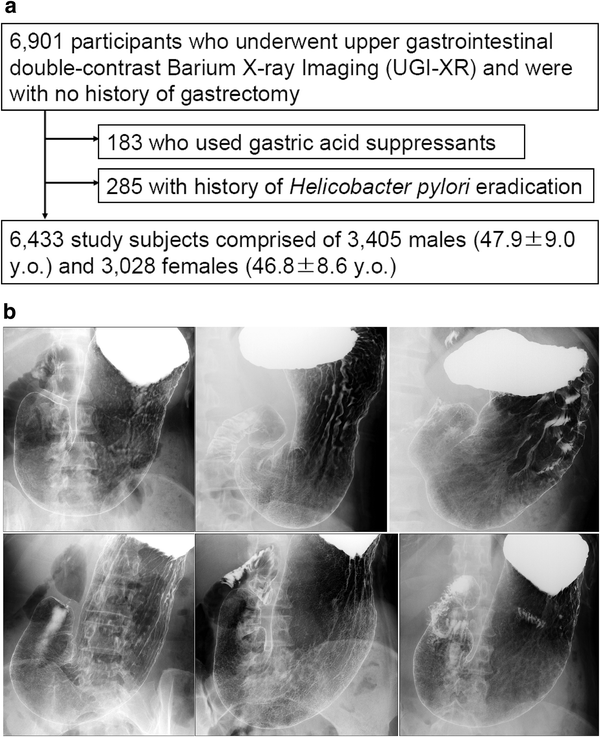 Atrophic gastritis and enlarged gastric folds diagnosed by double ...