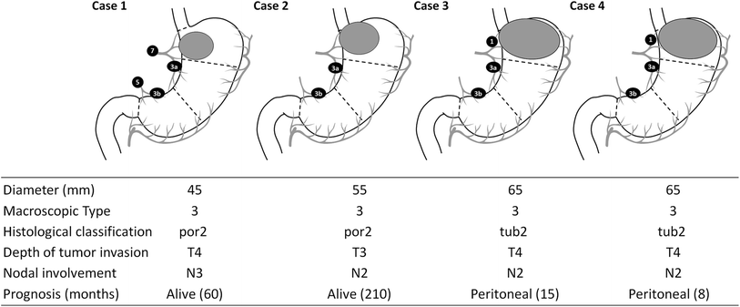 Proximal gastrectomy with exclusion of no. 3b lesser curvature lymph node dissection could be ...