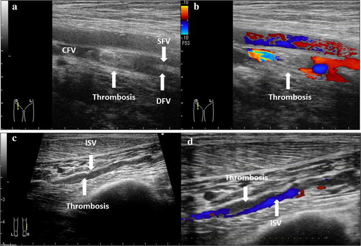 Prevalence of deep venous thrombosis detected by ultrasonography before ...