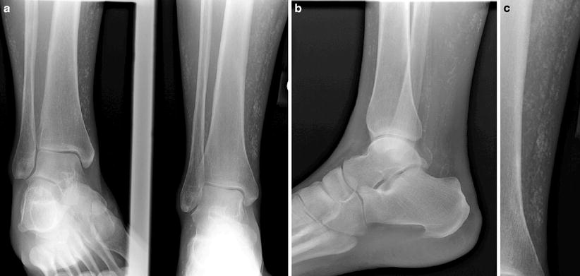 Soft tissue calcifications in the lower extremities of severely ...