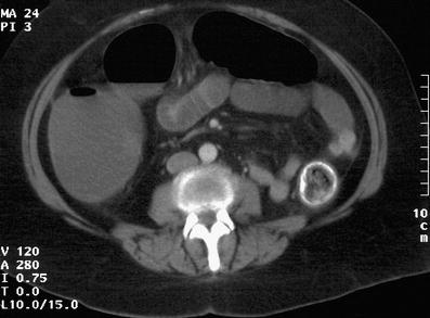 Calcified fecolith—a rare cause of large bowel obstruction | SpringerLink