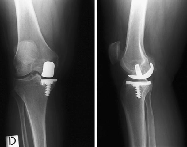 Popliteal artery pseudoaneurysm after a revision of total knee ...