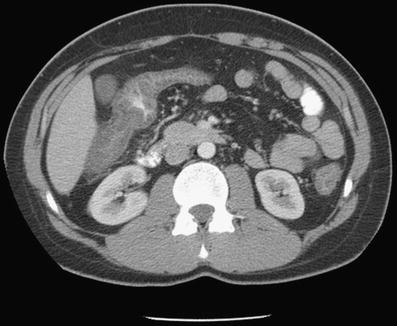 CT imaging of acute E. Coli-related colitis | SpringerLink