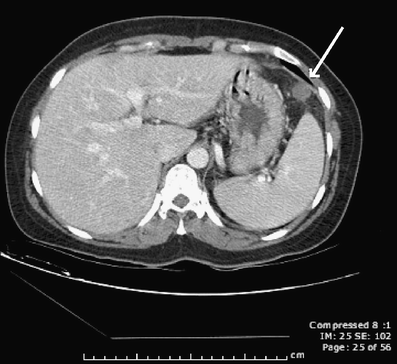Infarcted splenule—a case report | SpringerLink