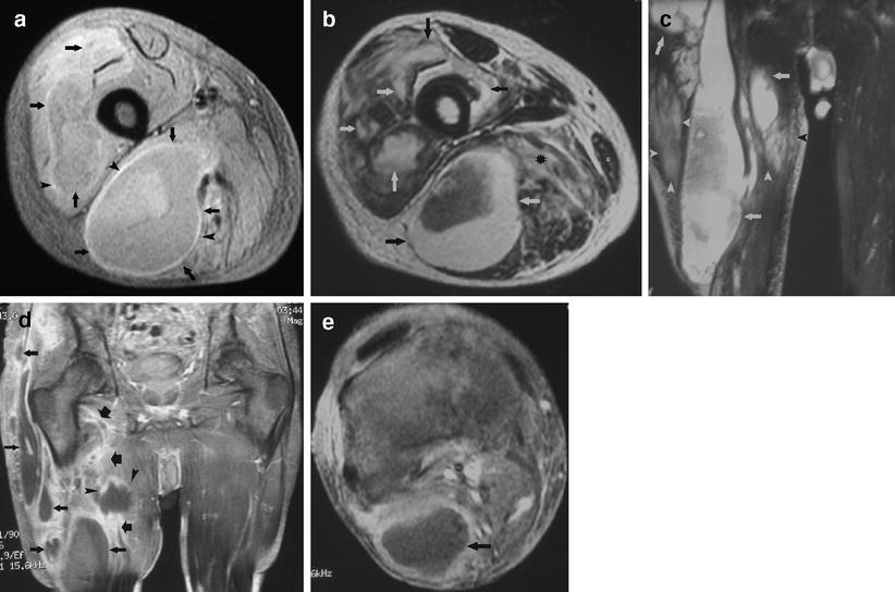 MR imaging findings of pyogenic bacterial myositis (pyomyositis) in ...