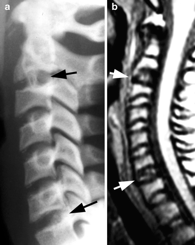 Calcific discitis in children: vertebral body involvement (possible ...