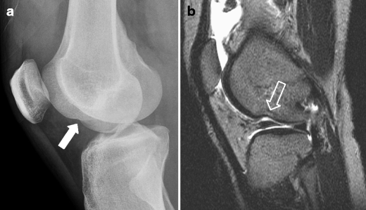 Radiographic indicators of acute ligament injuries of the knee: a ...