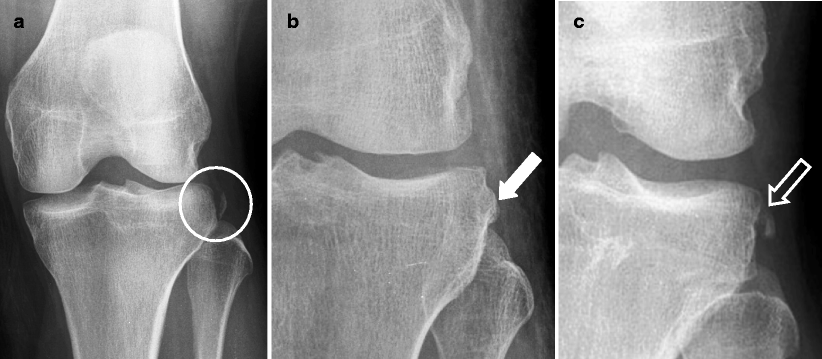 Radiographic indicators of acute ligament injuries of the knee: a ...