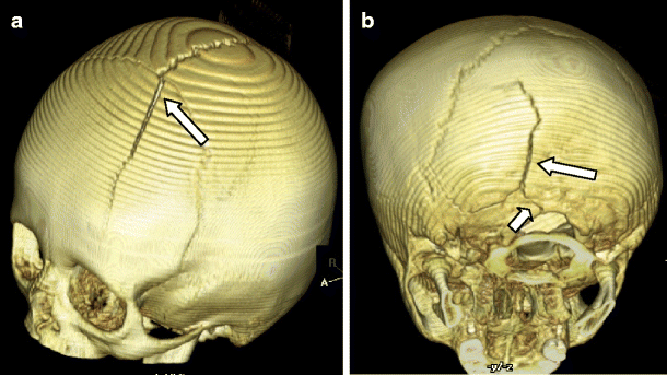 Skull fracture vs. accessory sutures: how can we tell the difference ...
