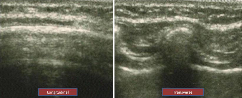 Evaluation by ultrasound of traumatic rib fractures missed by ...
