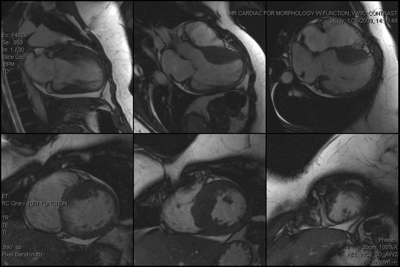Asymmetric septal hypertrophic cardiomyopathy: a case report | SpringerLink