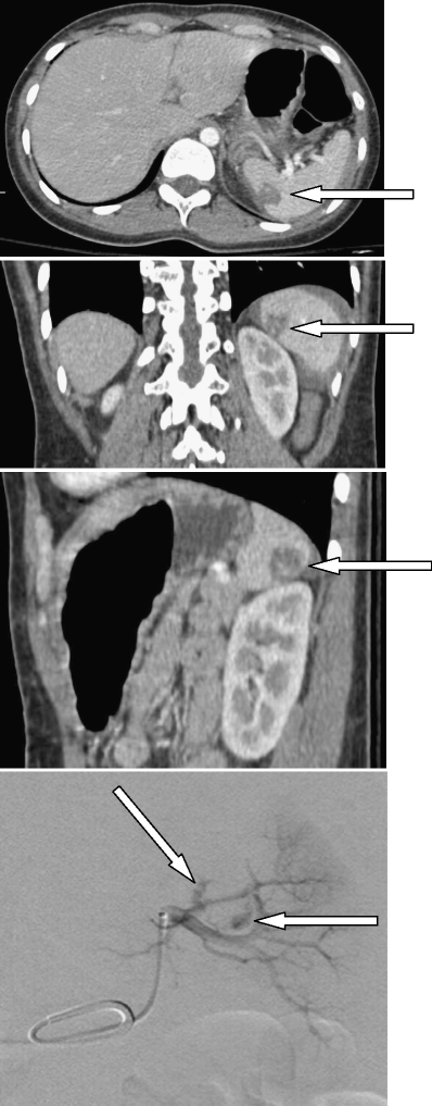 Splenic trauma: pictorial review of contrast-enhanced CT findings ...