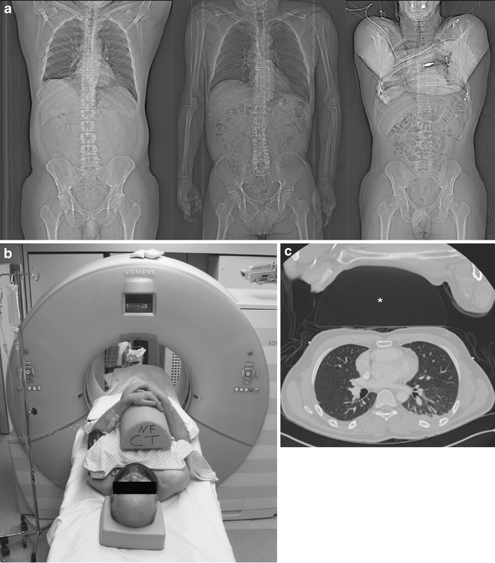 Whole-body CT in polytrauma patients: effect of arm positioning on ...