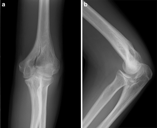 Medial condyle fracture of the distal humerus in an adolescent with pre ...