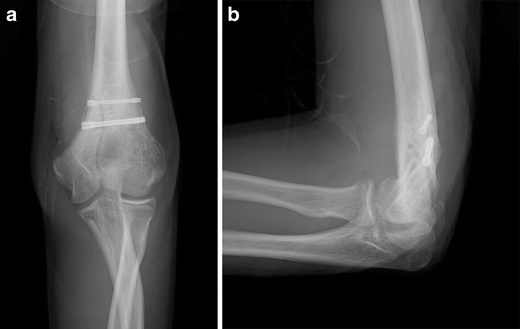 Medial condyle fracture of the distal humerus in an adolescent with pre ...