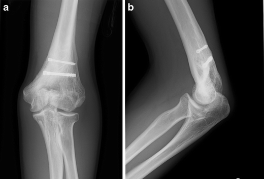 Medial condyle fracture of the distal humerus in an adolescent with pre ...