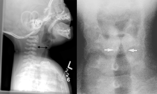 Analysing lateral soft tissue neck radiographs | SpringerLink