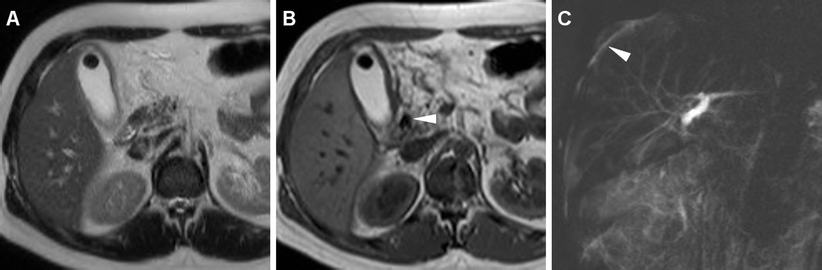 Urgent MRI with MR cholangiopancreatography (MRCP) of acute ...