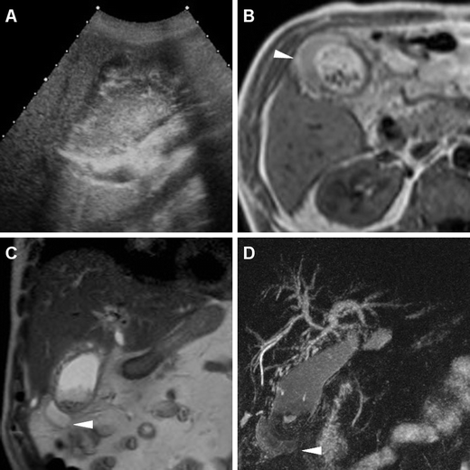 Urgent MRI with MR cholangiopancreatography (MRCP) of acute ...