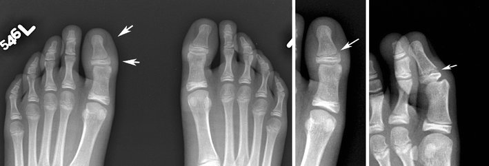 Musculoskeletal: what's different in children? Stubbed toe; pain for 2 ...