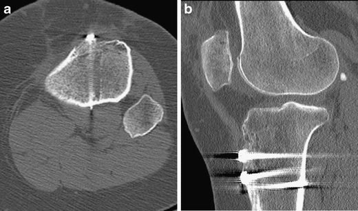 Transient lateral patellar dislocation: review of imaging findings ...
