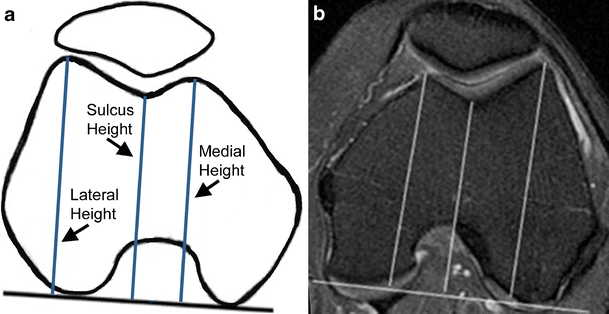 Transient lateral patellar dislocation: review of imaging findings ...