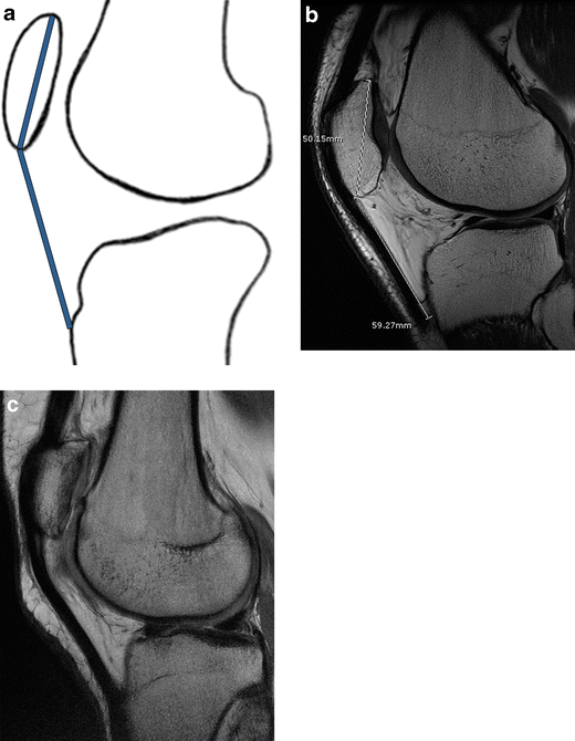 Transient lateral patellar dislocation: review of imaging findings ...